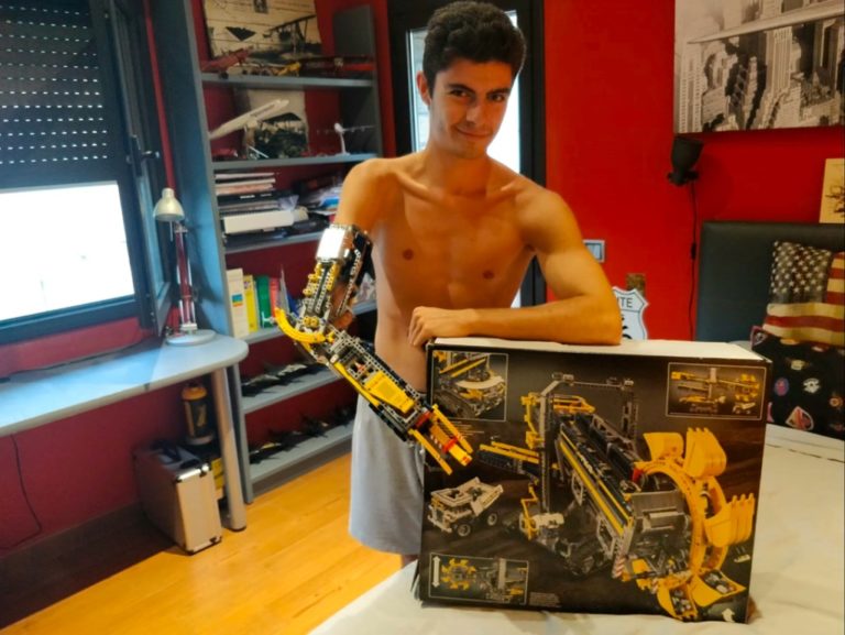 Teenager Builds Replacement Arm From Lego
